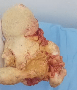 IMAGENS FORTES: veja como ficou o bebê calcificado por mais de 50 anos ...